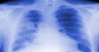 Asbestosis Overview: Causes, Symptoms, Treatment and More