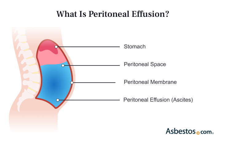 Peritoneal Effusion: Symptoms, Causes & Treatment