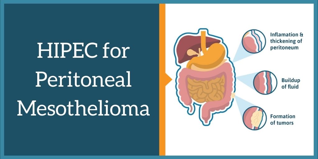 HIPEC for Mesothelioma: Process, Risks & Success Rate