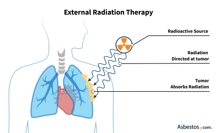 Mesothelioma Treatment with External Beam Radiation Therapy Mesothelioma Treatment with External Beam Radiation Therapy