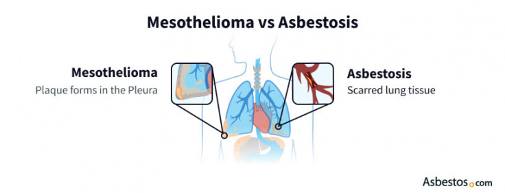 Asbestosis
