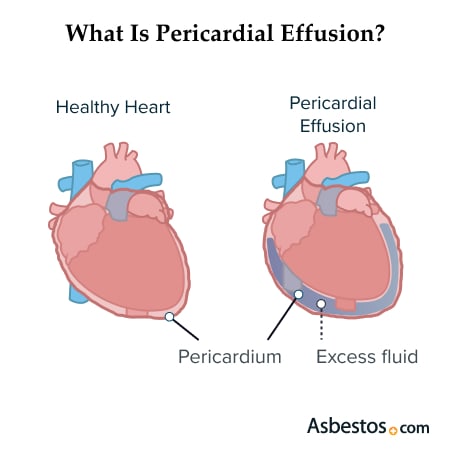 Pericardial Effusion: Symptoms, Causes and Treatments