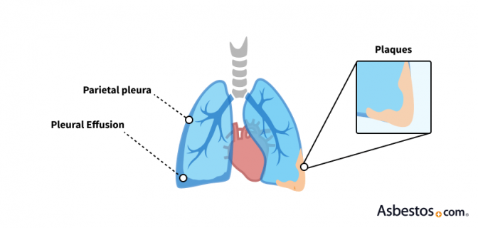List of Asbestos-Related Diseases