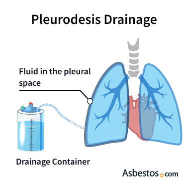Pleurodesis for Mesothelioma: How a Pleurodesis Can Help You