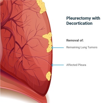 Mesothelioma Treatment | Surgery, Chemotherapy & Radiation Therapy
