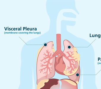 Top Mesothelioma Treatment Options for the Best Prognosis